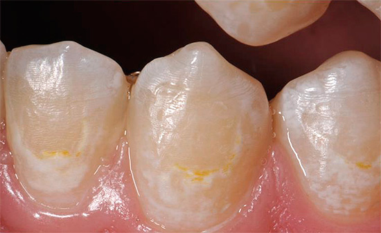Tienes caries? Estos son los síntomas » DTDental